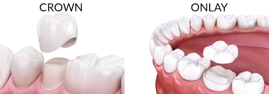 Dental Crowns & Onlays in Downtown Calgary | Cooper Dental